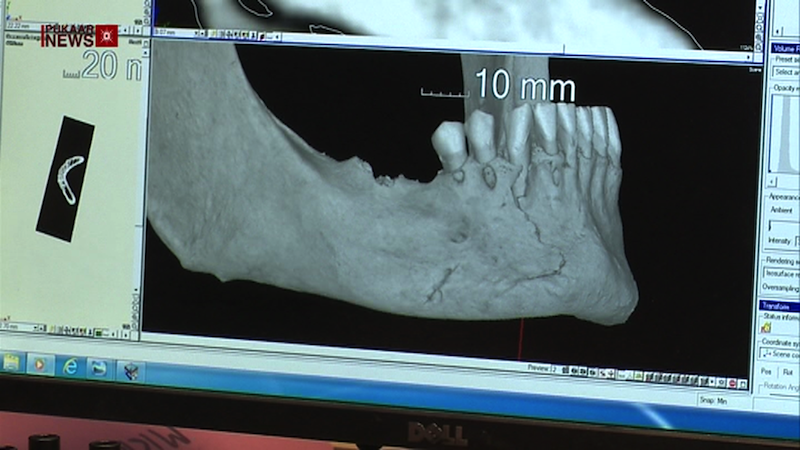 King Richard III: Battle of Bosworth Injuries Revealed